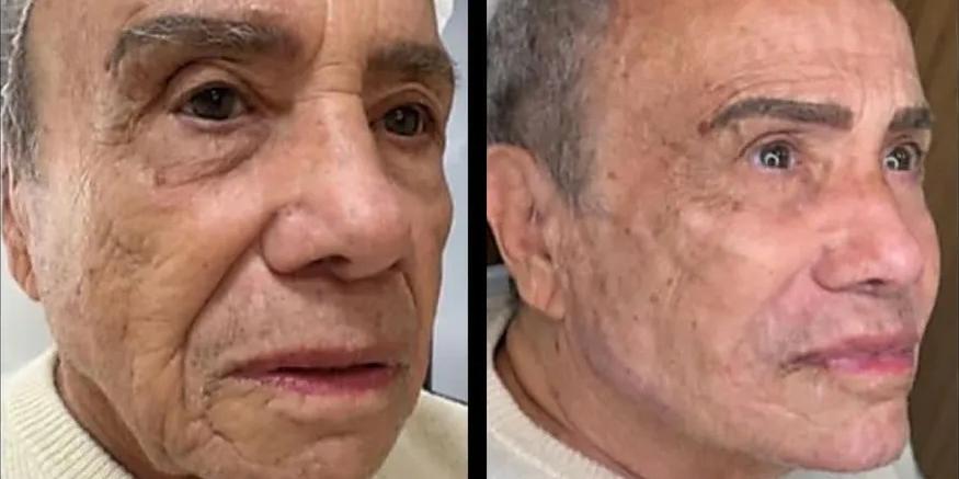 Stenio Garcio faz harmonização facial aos 91 anos; confira o resultado